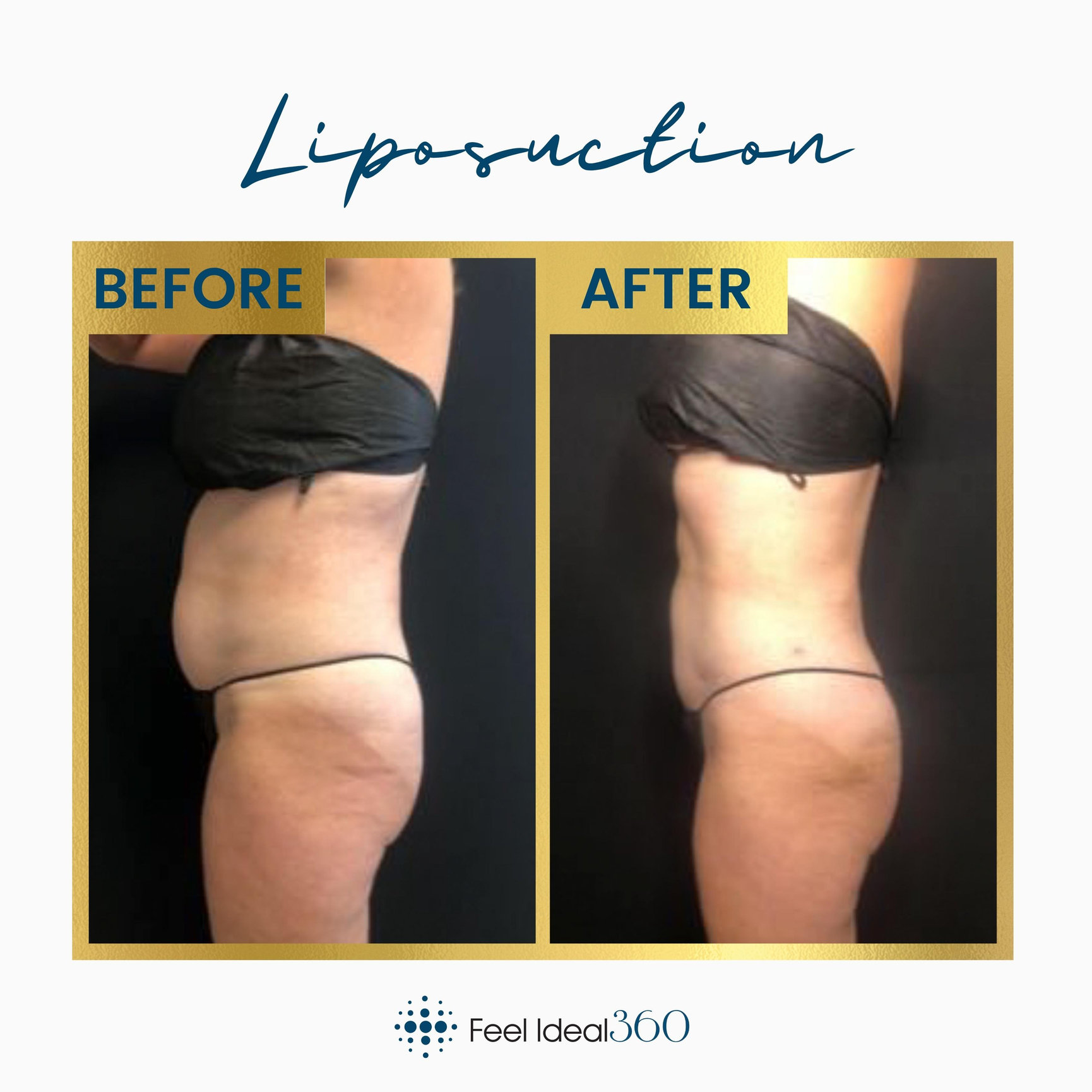Liposuction Before And After Southlake Texas Feel Ideal 360 Med Spa