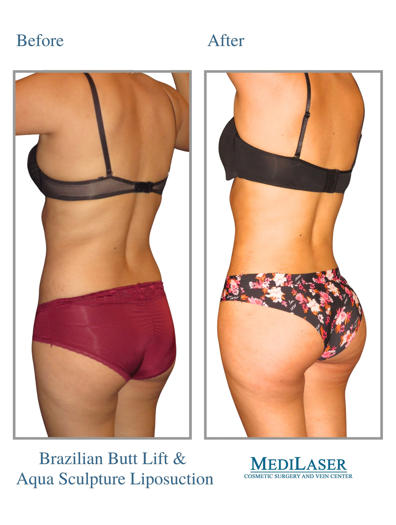 BBL Before & After | Medilaser | Frisco, TX