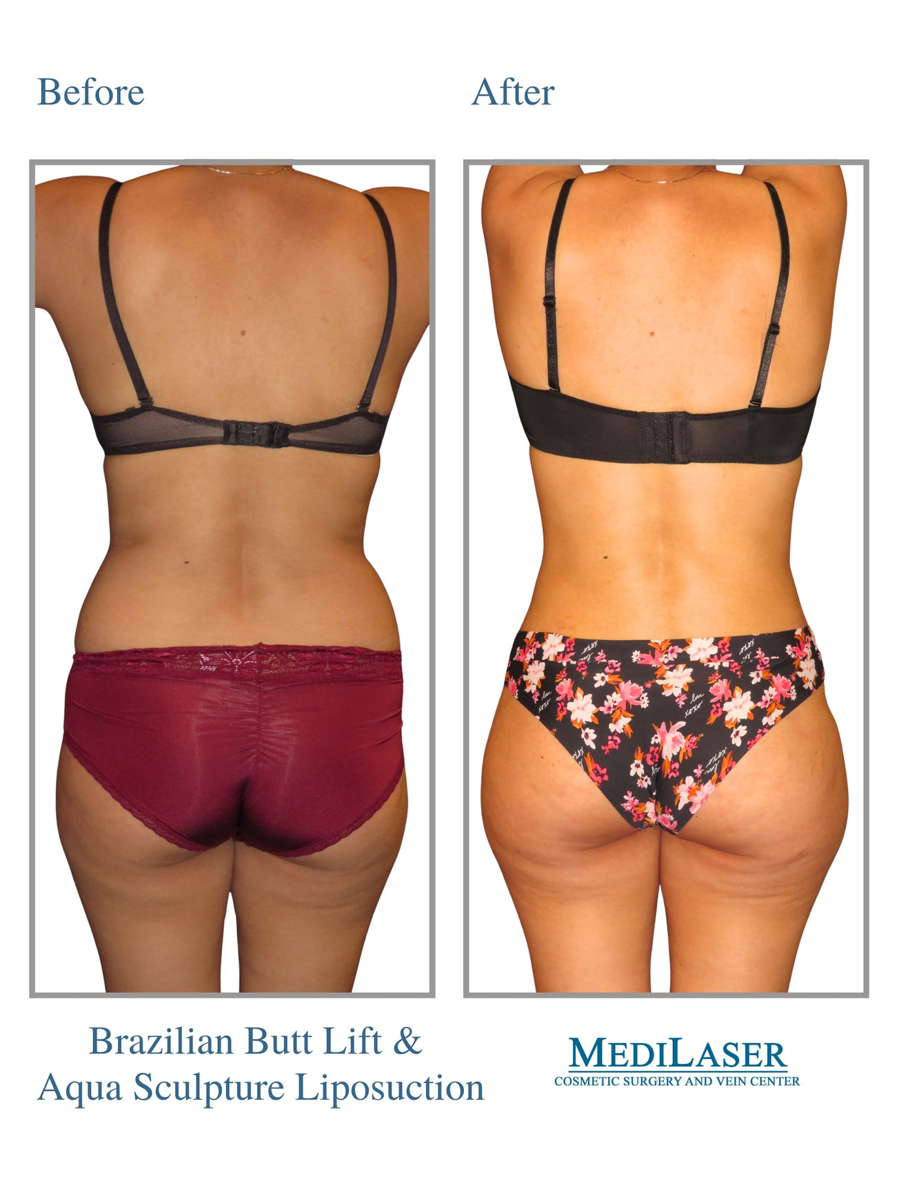 BBL Before & After | Medilaser | Frisco, TX